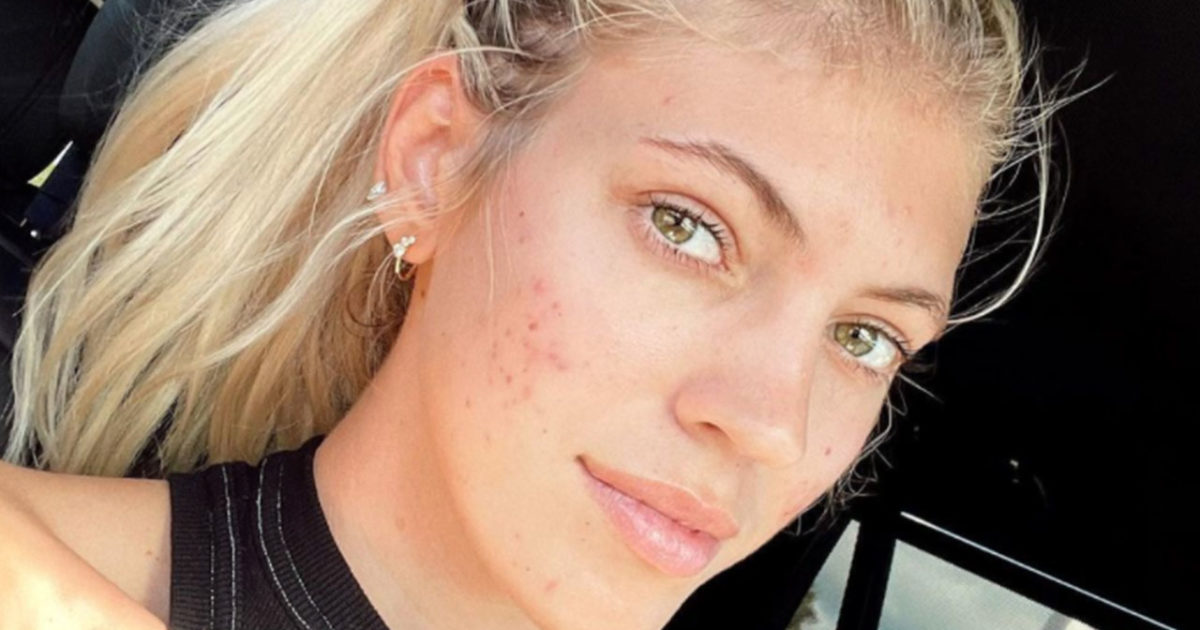 ¿Qué se siente tener acné siendo modelo? este ángel de Victoria´s ...